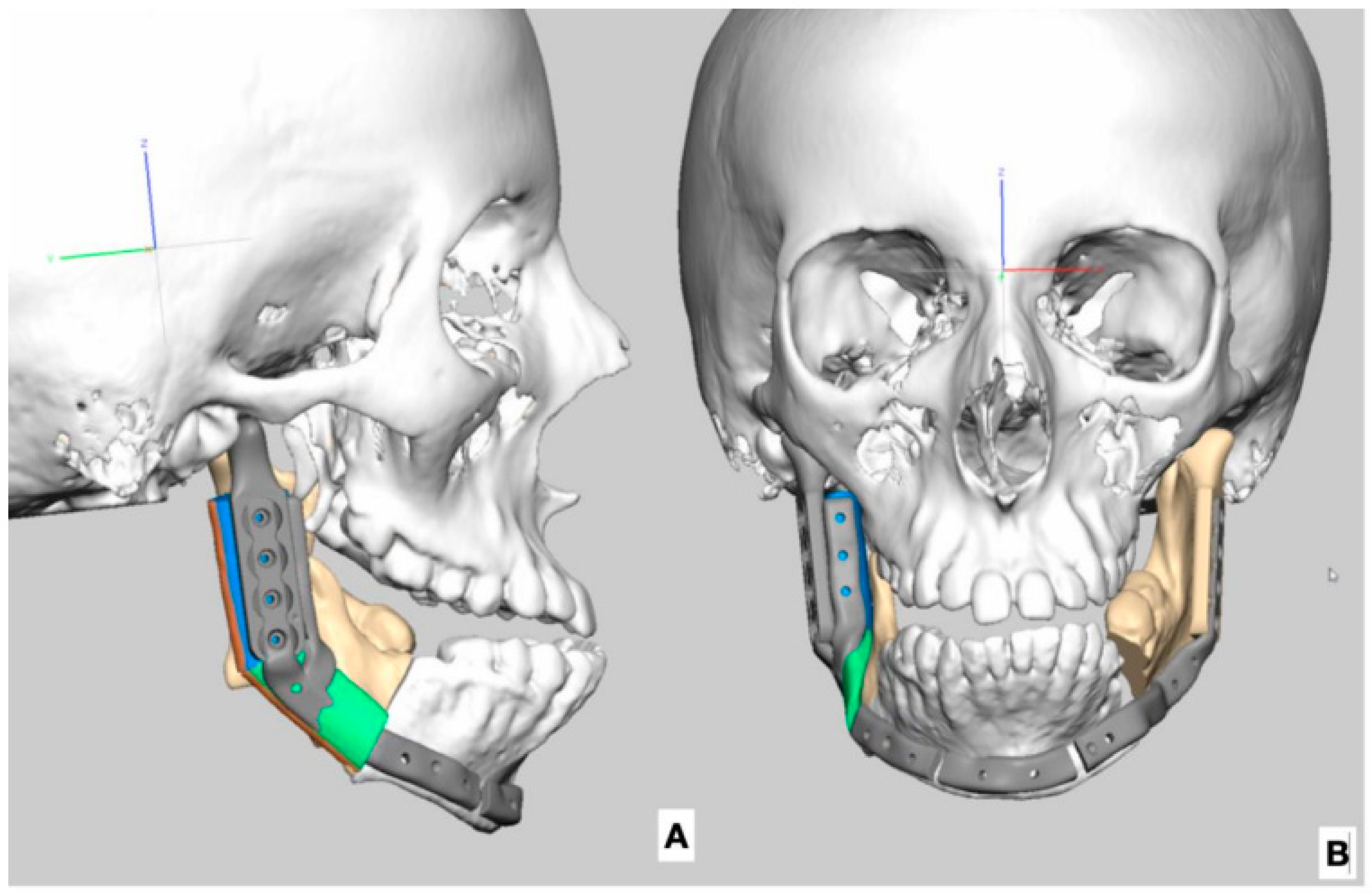 Use of a Fibula Free Flap for Mandibular Reconstruction in Severe ...