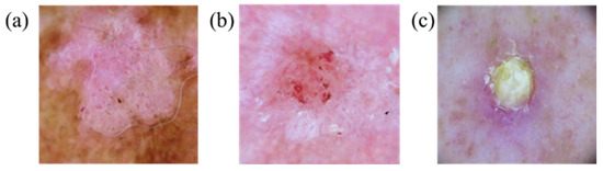 Classification of Skin Cancer Using Novel Hyperspectral Imaging ...
