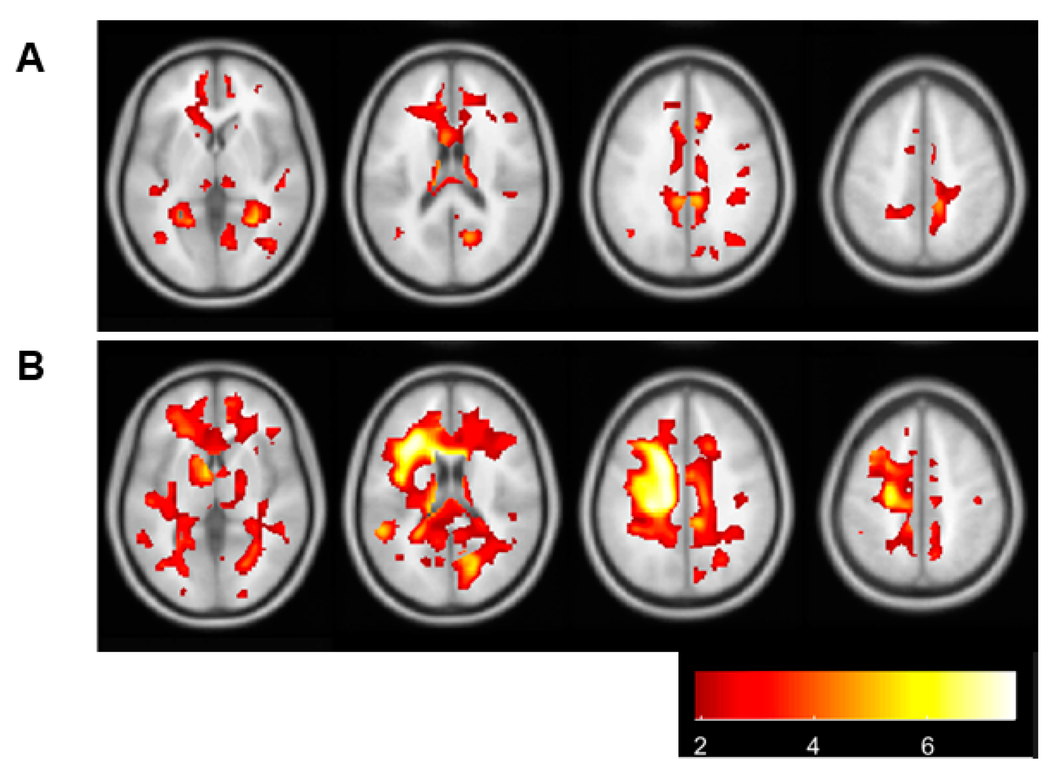 Association Between White Matter Hyperintensities Burden And Cognitive