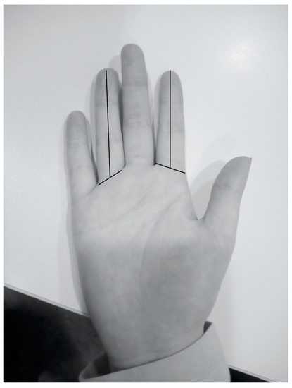 An Exploratory Analysis on the 2D:4D Digit Ratio and Its Relationship ...