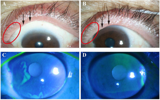 Effect of Hypochlorous Acid on Blepharitis through Ultrasonic ...