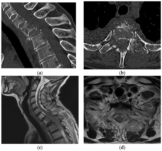 Does the Pathologic Fracture Predict Severe Paralysis in Patients with ...