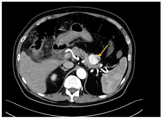 JCM | Free Full-Text | Safety and Efficacy of Surgery for Metastatic ...