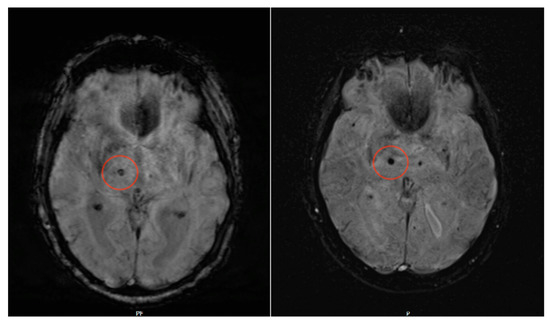 Prospective Assessment of Cerebral Microbleeds with Low-Field Magnetic ...