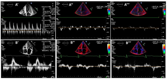 Cardiac Contractility Modulation Therapy in Patients with Amyloid ...