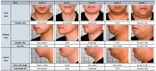 The Study of a Validated Assessment Scale for a Localized Submental Fat ...