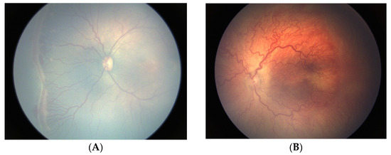 Retinopathy of Prematurity in the 21st Century and the Complex Impact ...