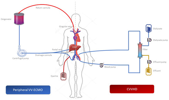 Planned Extracorporeal Life Support Employment during Liver Transplantation: The Potential of ...