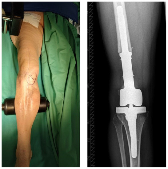 Impact and Modification of the New PJI-TNM Classification for ...