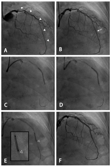 Outcomes of Percutaneous Coronary Interventions for Long Diffuse ...