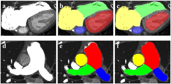 Machine Learning Based on Computed Tomography Pulmonary Angiography in ...