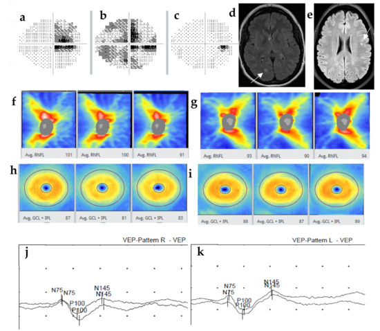 The Importance of Optical Coherence Tomography in the Diagnosis of ...