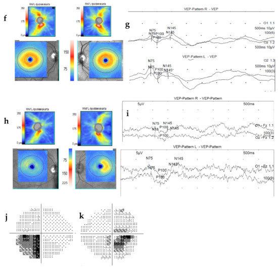The Importance of Optical Coherence Tomography in the Diagnosis of ...