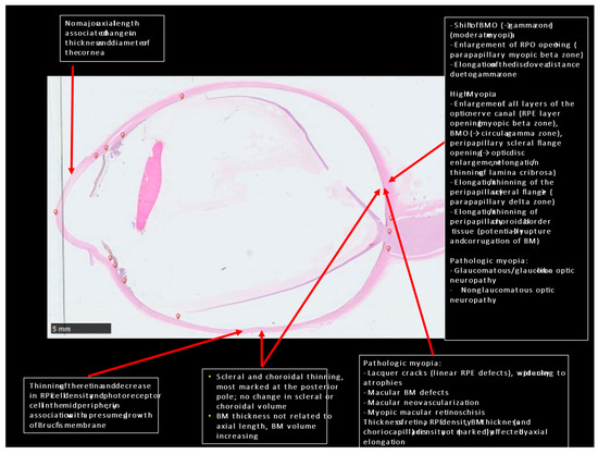 Anatomic Peculiarities Associated with Axial Elongation of the Myopic Eye