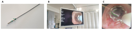 Bronchoscopic Endobronchial Valve Therapy for Persistent Air Leaks in ...
