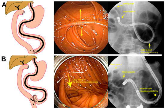 Gastric Bypass Billroth I Versus Billroth Ii Anatomy