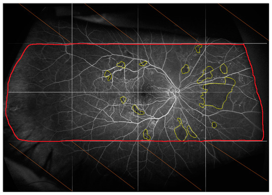 Ultra-Wide-Field Fluorescein Angiography Assessment of Non-Perfusion in ...
