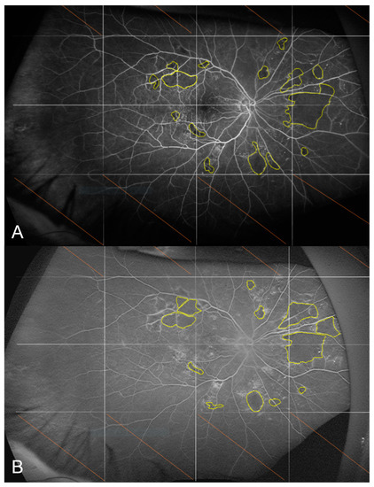 Ultra-Wide-Field Fluorescein Angiography Assessment of Non-Perfusion in ...