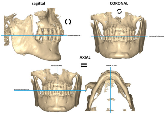 Soft- and Hard-Tissue Thicknesses in Patients with Different Vertical ...
