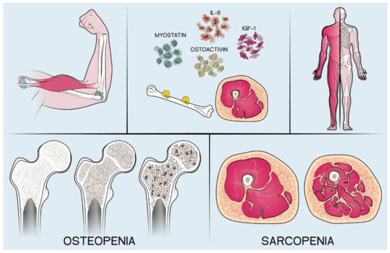 Complications after Posterior Lumbar Fusion for Degenerative Disc Disease: Sarcopenia and ...