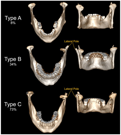 Current Frequency of Mandibular Condylar Process Fractures