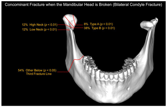 Current Frequency of Mandibular Condylar Process Fractures