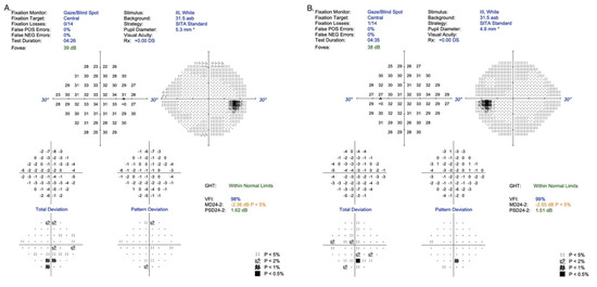 Observations for Sjögren’s Pigment Epithelial Reticular Dystrophy in a ...