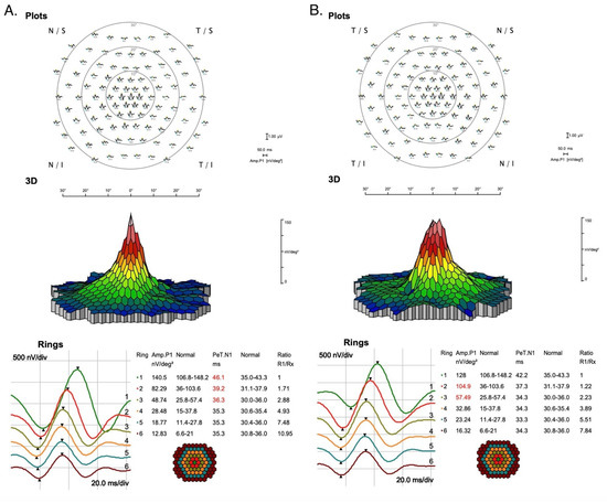 Observations for Sjögren’s Pigment Epithelial Reticular Dystrophy in a ...