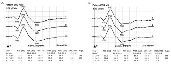 Observations for Sjögren’s Pigment Epithelial Reticular Dystrophy in a ...