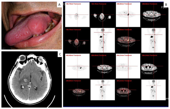 Metastatic Lung Cancer to the Head and Neck: A Clinico-Pathological ...