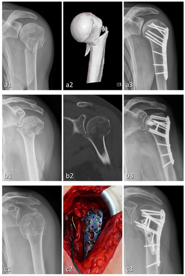 Treatment Reality of Proximal Humeral Fractures in the Elderly—Trending ...