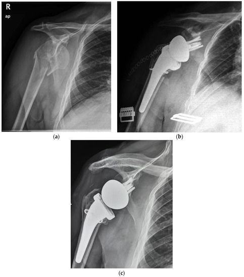 Reverse Total Shoulder Arthroplasty with a Cementless and Metaphyseal ...