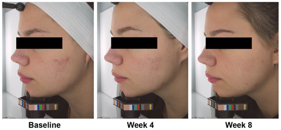 Prospective Evaluation of a Topical Botanical Skin Care Regimen on Mild ...