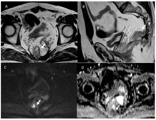 Jcm Free Full Text Post Surgical Imaging Assessment In Rectal