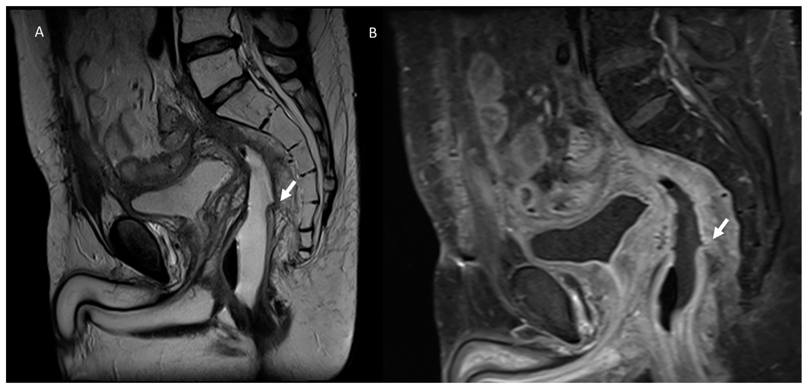 Jcm Free Full Text Post Surgical Imaging Assessment In Rectal