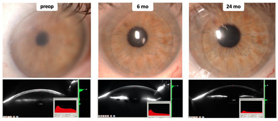Corneal Optical Densitometry in the Evaluation of 2-Year Graft Function ...