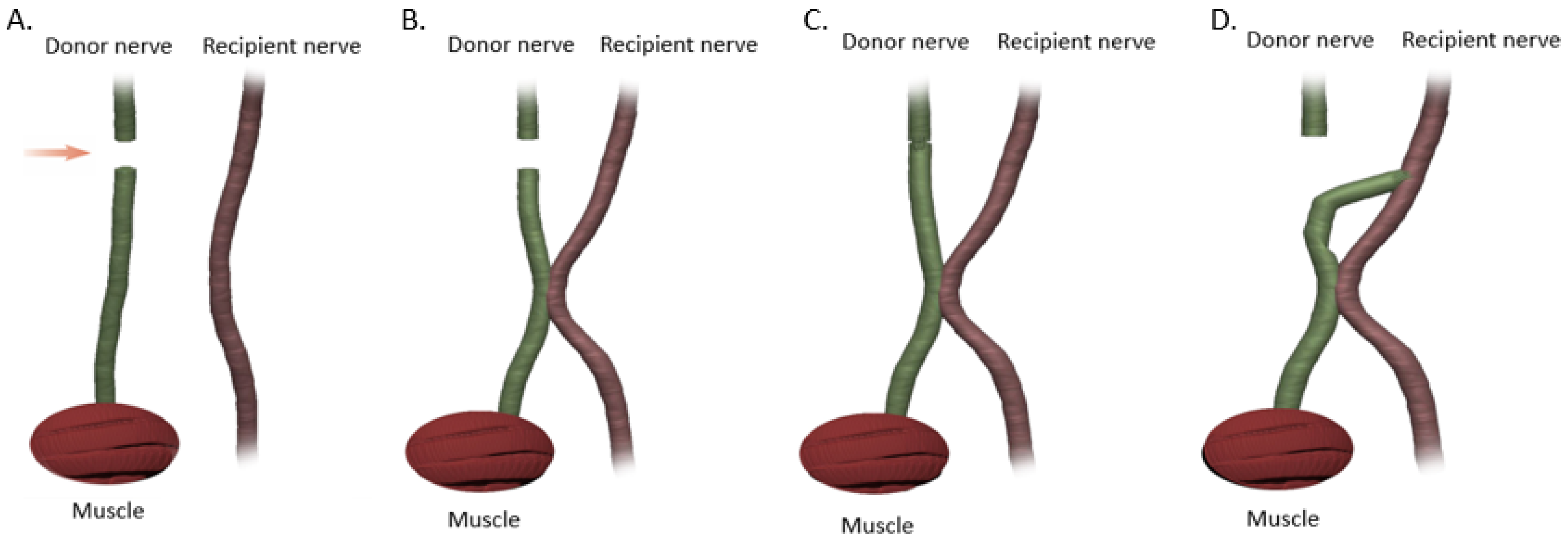 Molecular Basis of Surgical Coaptation Techniques in Peripheral Nerve ...