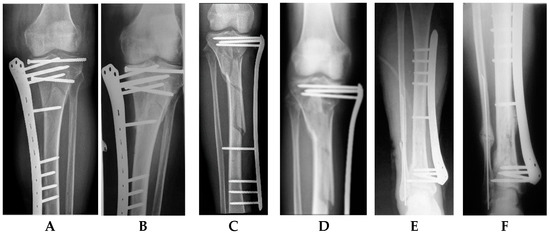 Single-Stage Externalized Locked Plating for Treatment of Unstable Meta-Diaphyseal Tibial Fractures