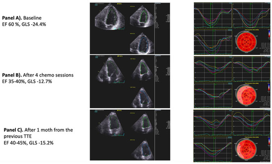 Exploring the Cardiotoxicity Spectrum of Anti-Cancer Treatments ...