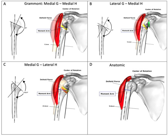 Challenges for Optimization of Reverse Shoulder Arthroplasty Part II ...