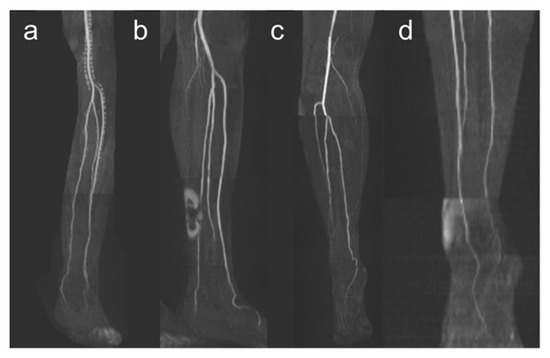 Evaluation of Lower Leg Arteries and Fibular Perforators before ...
