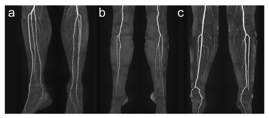 Evaluation of Lower Leg Arteries and Fibular Perforators before ...