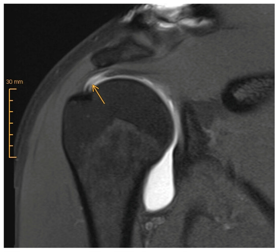 Current Understanding and New Advances in the Surgical Management of ...