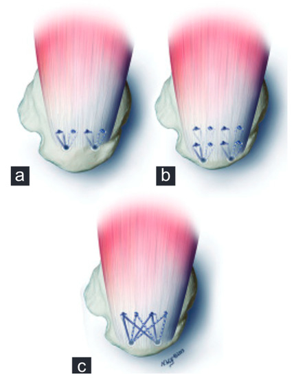 Current Understanding and New Advances in the Surgical Management of ...