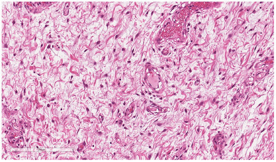 Aggressive Angiomyxoma of the Vulva: Which Is the Best Management ...