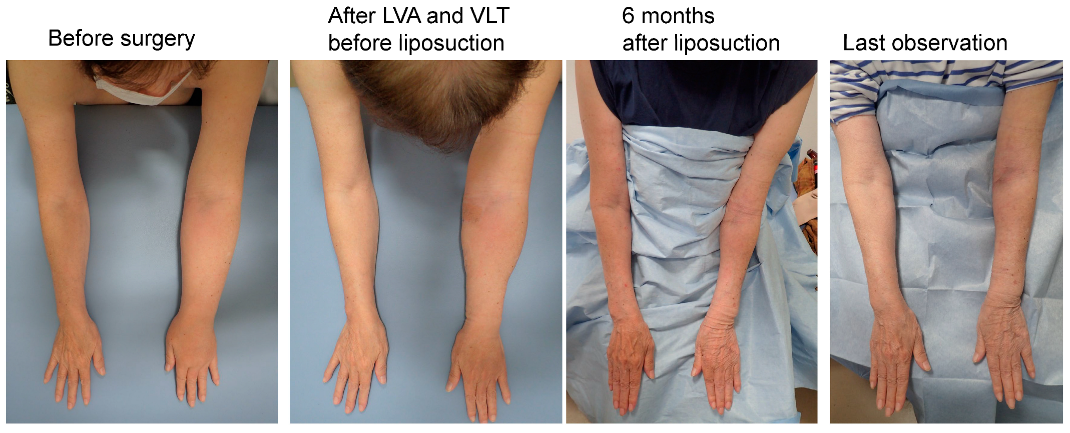 Comparison of the Effectiveness of Liposuction for Lower Limb versus ...