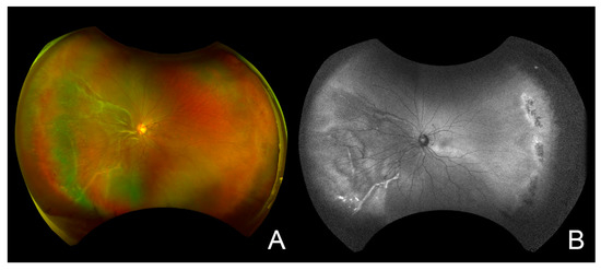 Rhegmatogenous Retinal Detachment in Musculocontractural Ehlers–Danlos ...