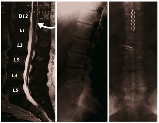“Neuro-Fiber Mapping”: An Original Concept of Spinal Cord Neural ...