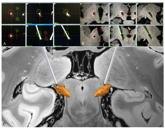 Deep Brain Stimulation Electrode Reconstruction: Comparison between Lead-DBS and Surgical ...