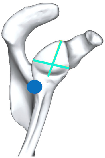 Challenges for Optimization of Reverse Shoulder Arthroplasty Part I ...